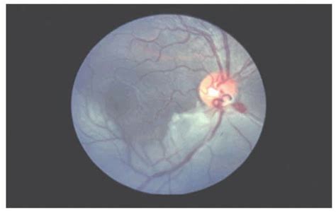 Congenital Abnormalities Of The Optic Disk Ento Key