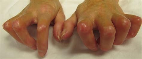 Systemic Scleroderma Hands