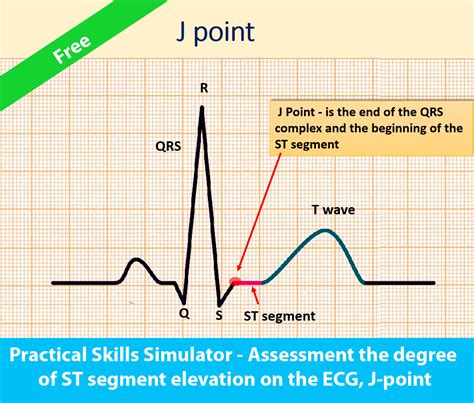 St Segment Elevation Ecg