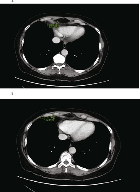 Pericardial Lymph Node