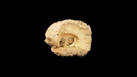 Limbic System Dissection With Ant Commissure 3d Model By 3d2u Swu