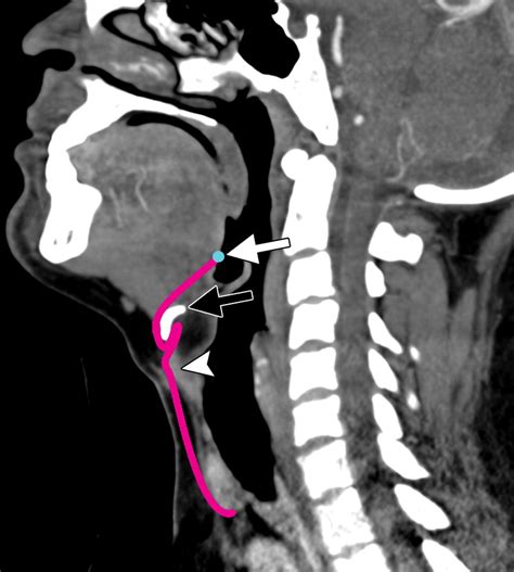 Imaging Of Ectopic Thyroid Tissue And Thyroglossal Duct Cystsradiographics