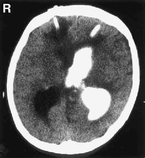 Septostomy Ventricle