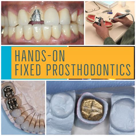 Fixed Prosthodontics Simplified Hands On Courses Ce Courses