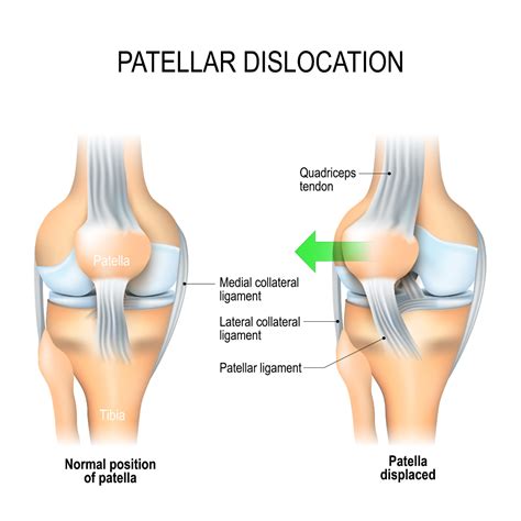 Knee Dislocation Reduction