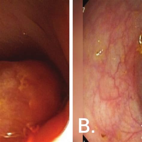 A B Polyps Seen In Sigmoidoscopy Download Scientific Diagram