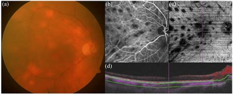 Multimodal Imaging Of Stromal Choroiditis A Fundus Photograph Shows