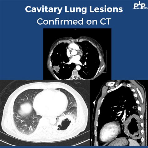 Pulmpeeps Pulmonary And Critical Care Content For Learners And