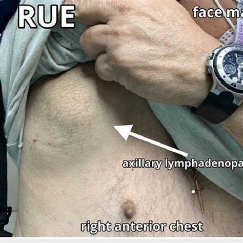 Initial Presentation Of Right Axillary Swelling Noted On 11421 Two
