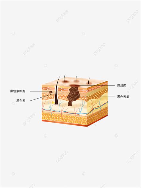 Tumors Vector Hd Images Schematic Diagram Of Black Tumor Exhibition