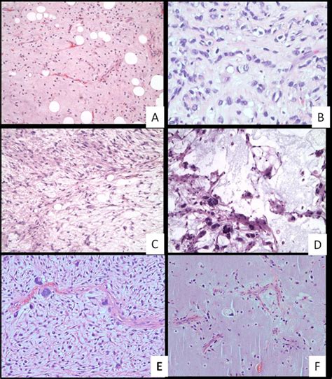 Histological Features Of Myxoid Liposarcoma And Myxofibrosarcoma A