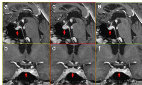 Ipilimumab Induced Hypophysitis Mr Findings
