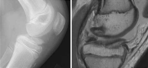 A New Mri Based Classification System For Tibial Spine Fractures