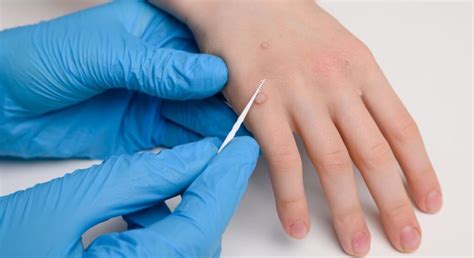 Tipuri De Veruci și Imagini Pentru A Le Recunoaște Mai Ușor Dr