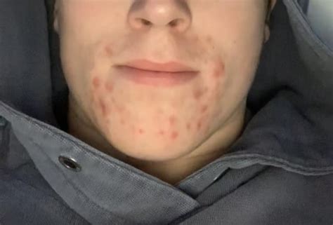 Is This Purging Raccutane