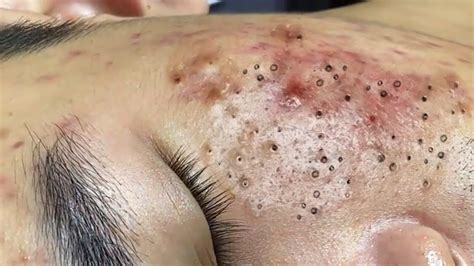 Big Cystic Acne Blackheads Extraction Blackheads And Milia Whiteheads Removal Pimple Popping