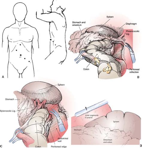 Laparoscopic Splenectomy Basicmedical Key