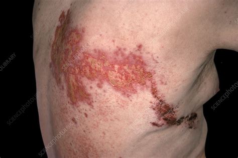Shingles Rash Stock Image C062 0746 Science Photo Library