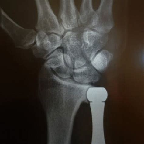 Migration Of The Ulnar Head Prothesis In The Distal Radius Download Scientific Diagram