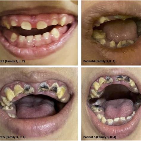 Dental Anomalies Illustrative Images From The Selected Patients
