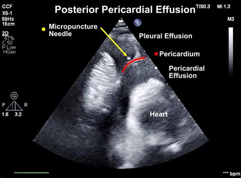 Artificial Left Pleural Effusion To Facilitate Ultrasound Guided