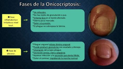 Patologías Ungueales Onicocriptosis Onicomicosis Y Onicogrifosis