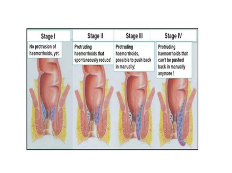 Hemorrhoid Pptx
