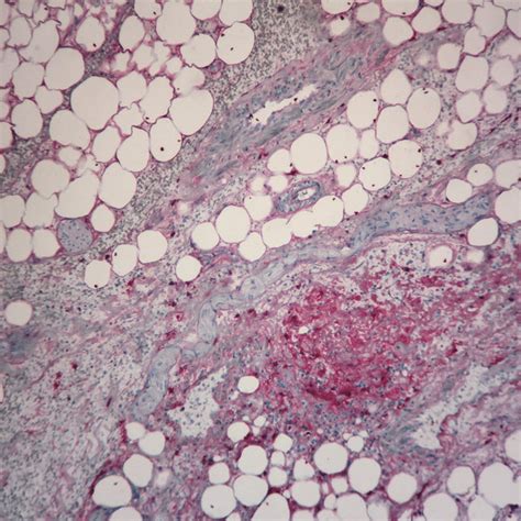 Detection Of Fibronectin By Immunohistochemical Staining × 100