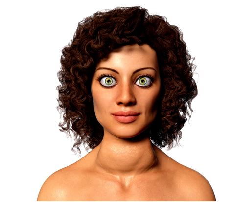 Eye Signs Of Thyroid Disease My Endo Consult