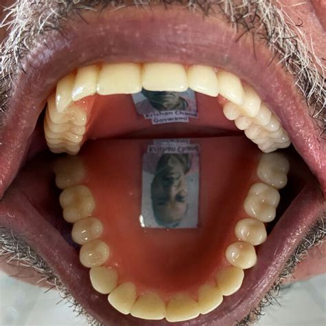Postoperative View Showing Denture Marking Download Scientific Diagram