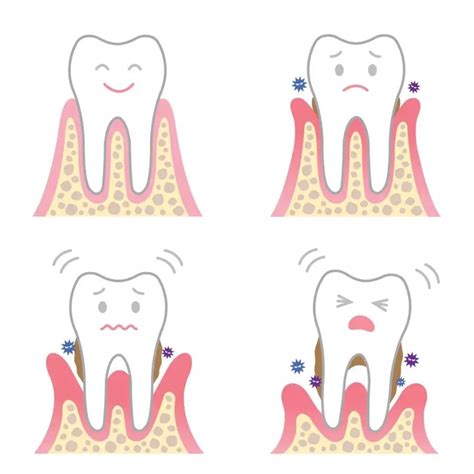 牙周炎科普，看看是不是你的误区 知乎
