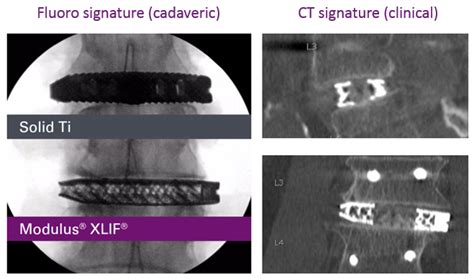 Nuvasive 3d Prints Microporous Surfaces And Optimized Lattices For