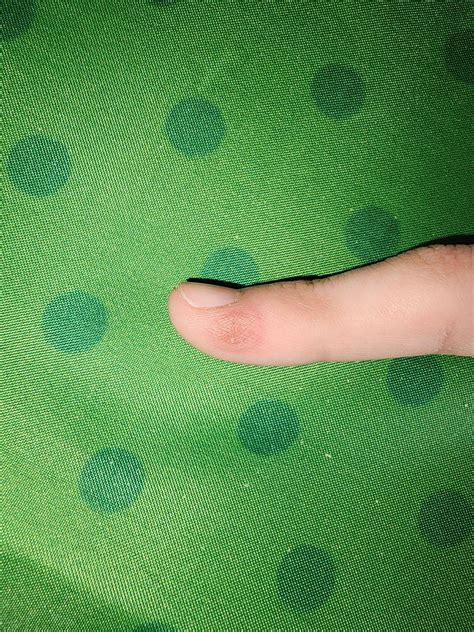 Do I Have Ringworm On My Finger R Dermatologyquestions