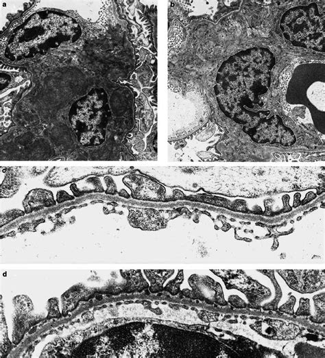 Ultrastructural Examination Of Glomeruli By Electron Microscopy