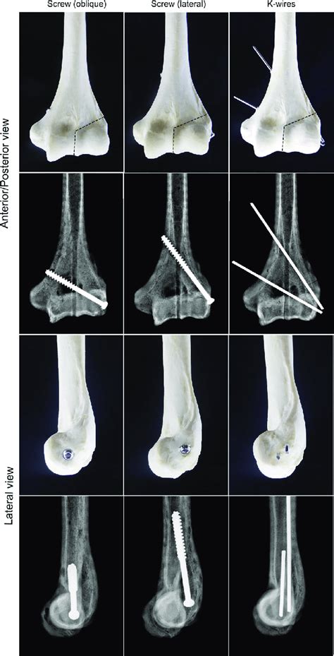 Lateral Condyle Fracture Milch