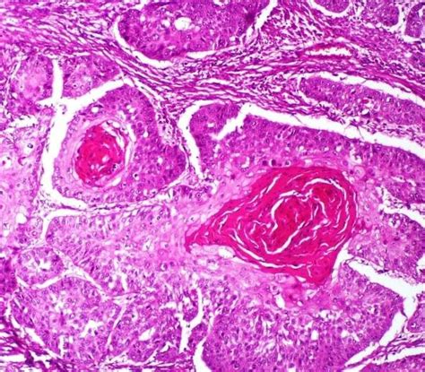 Figure1 Several Degrees Of Keratinization Are Observed Through Tumor