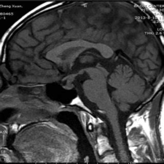 Initial Sagittal T1 Brain Mri 1 Download Scientific Diagram