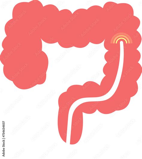 Colon Cancer Colonoscope In The Colon Polyp Removal 2d Illustration 대장용종 담낭석 담석 담낭염 담석증