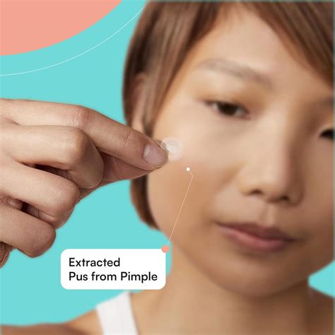 Skinchoice Breakout Pimple Plaster 75 Hydrocolloid Acne Treatment