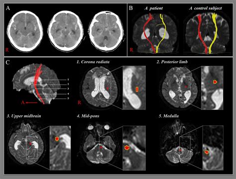 Spinothalamic Tract Midbrain