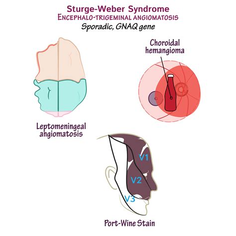 Clinical Pathology Glossary Sturge Weber Syndrome Ditki Medical And Biological Sciences