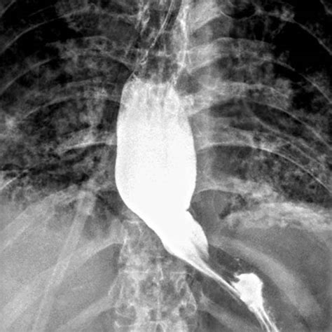 Esophageal Scleroderma Radiology Key