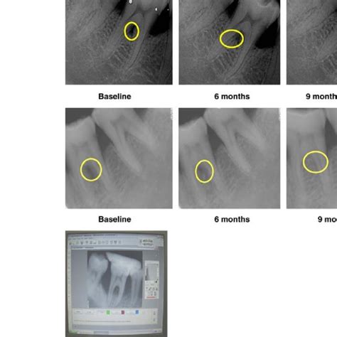 Pdf A Clinical And Radiological Evaluation Of Dfdba With Amniotic