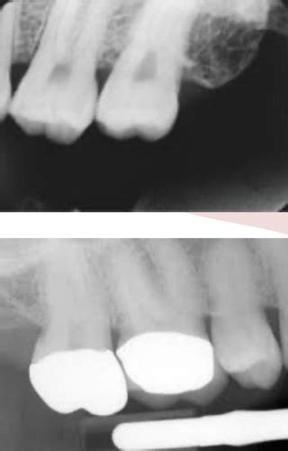 Den106l Technique Errors Flashcards Quizlet