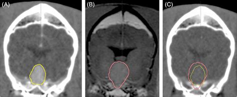 Treatment Outcomes And Target Delineation Utilizing Ct And Mri In 13