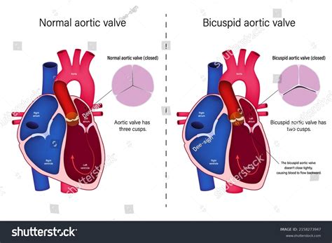 Aortic Valve Anatomy