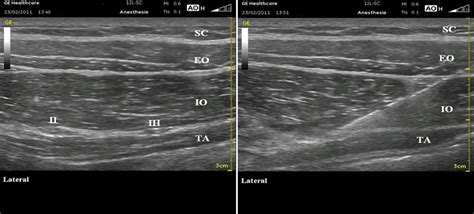 Ultrasound Guided Ilioinguinal Iliohypogastric Nerve Blocks