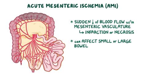 Mesenteric Artery Ischemia