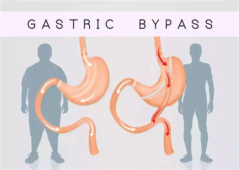 Mini Bypass Vs Bypass Which Weight Loss Surgery Is Best