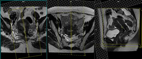 Mri Of The Cervix In The Midsagittal Plane Upper Arrow Uterus 395x547
